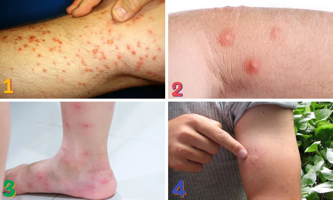 Safe Care Blog | Gigitan Semut: Gejala, Jenis, Cara Mengobati, dan ...