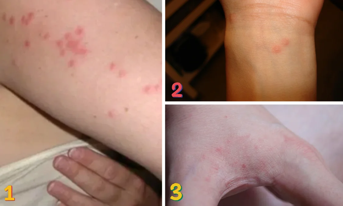 Safe Care Blog | Gigitan Tungau Kasur: Gejala, Jenis, Cara Mengobati ...